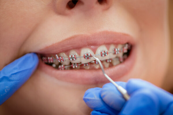 How Do Braces Work? - Goldkind Family Ortho